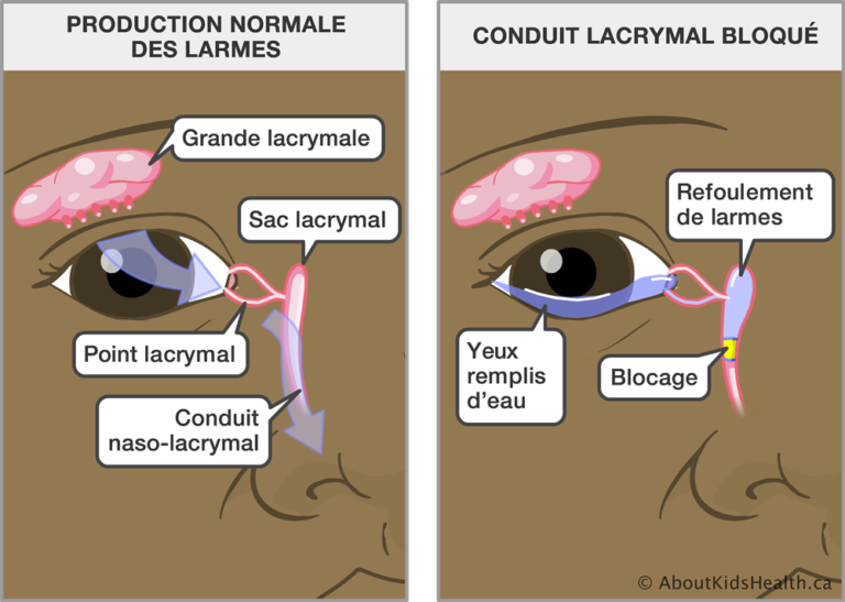 Le canal lacrymal bouché – Grandir.
