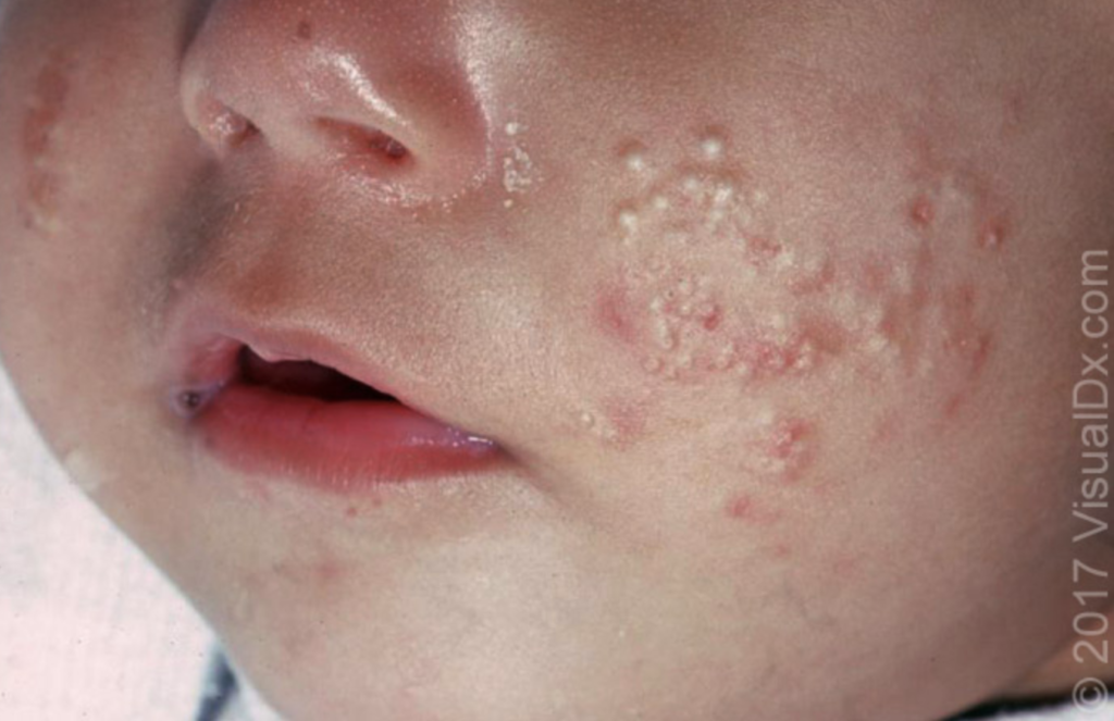 L'érythème toxique du nouveau-né - Grandir.